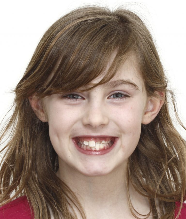 Phase 1 Braces - Soleil Orthodontics