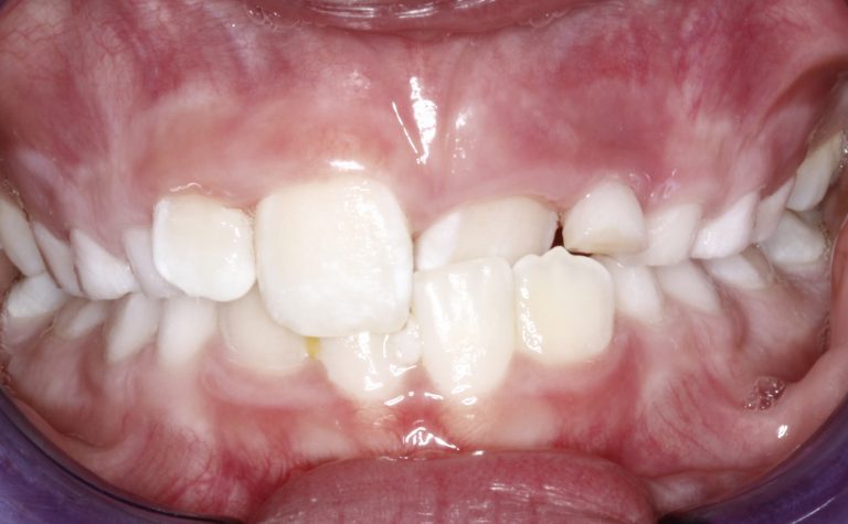 Phase 1 Braces - Soleil Orthodontics