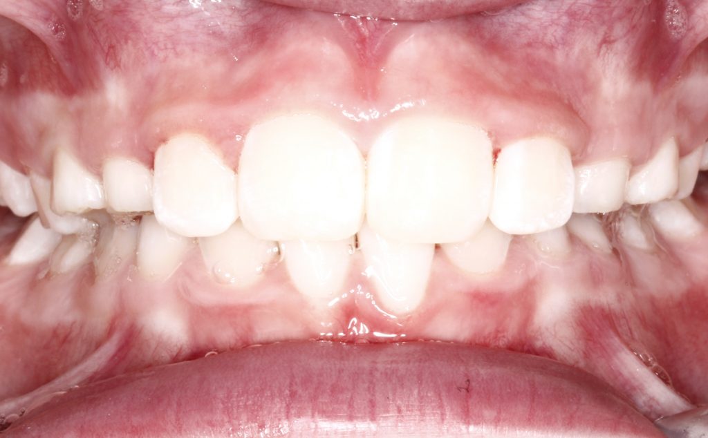 Phase 1 Braces - Soleil Orthodontics